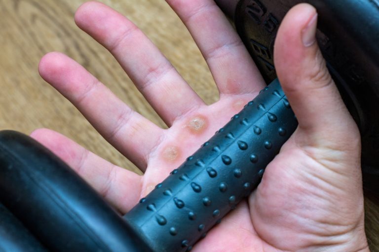 How to Get Rid of Calluses From Lifting - muscleandstrong.com